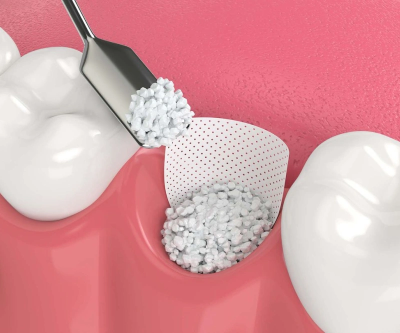 Bone Grafting The Woodlands TX | The Woodlands Dentistry and Orthodontics