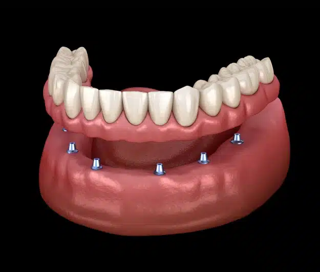 Dental Implants The Woodlands TX | The Woodlands Dentistry and Orthodontics