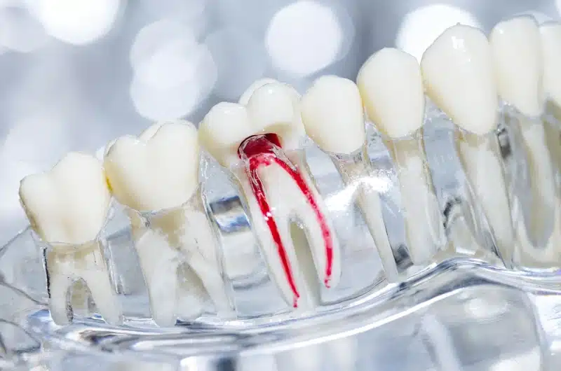 Root Canal Therapy The Woodlands TX | The Woodlands Dentistry and ...