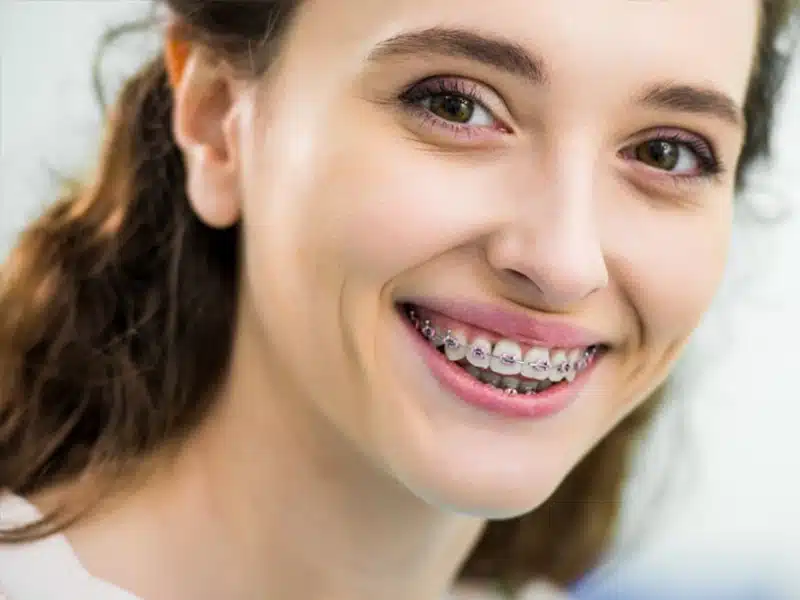 Traditional Braces in The Woodlands, TX | Dentistry and Orthodontics